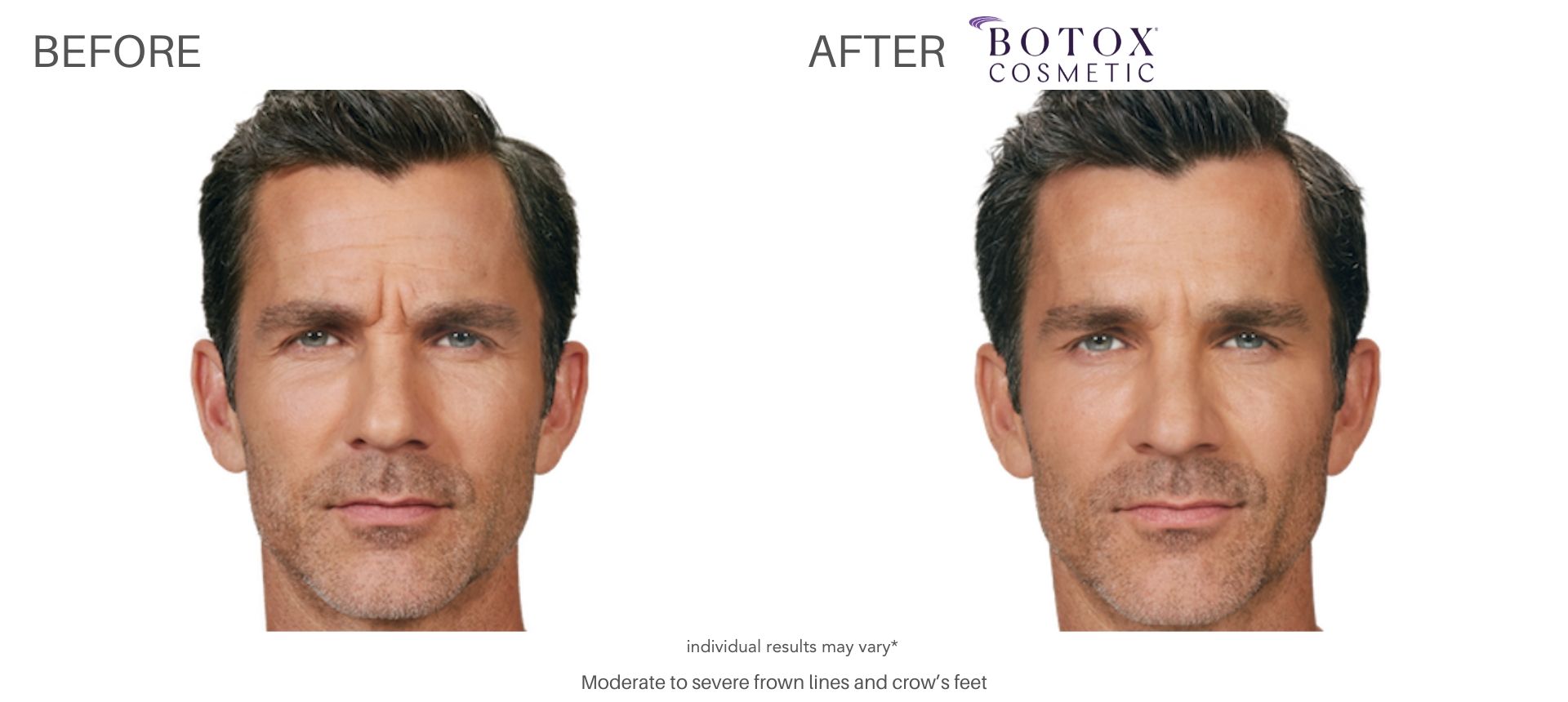 Botox for Men Olney Maryland